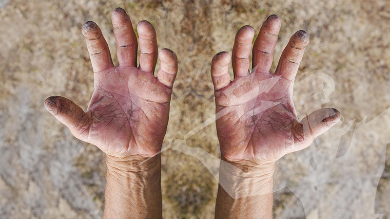 Manos secas y agrietadas: causas y remedios