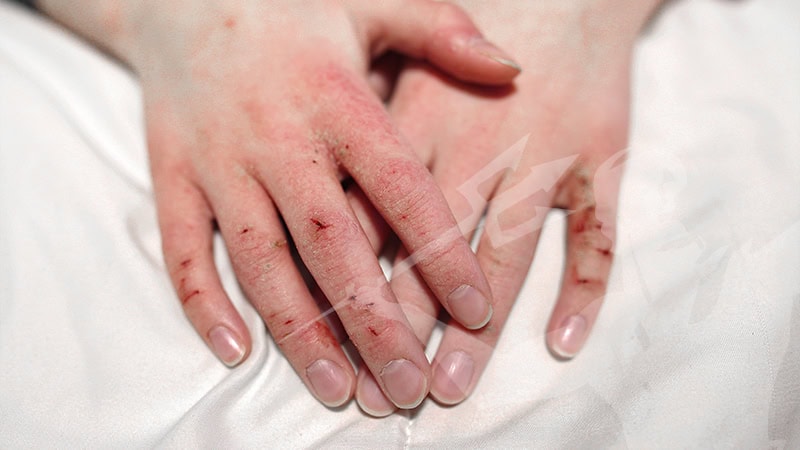 Bacteria on hands: what are they and what are the risks
